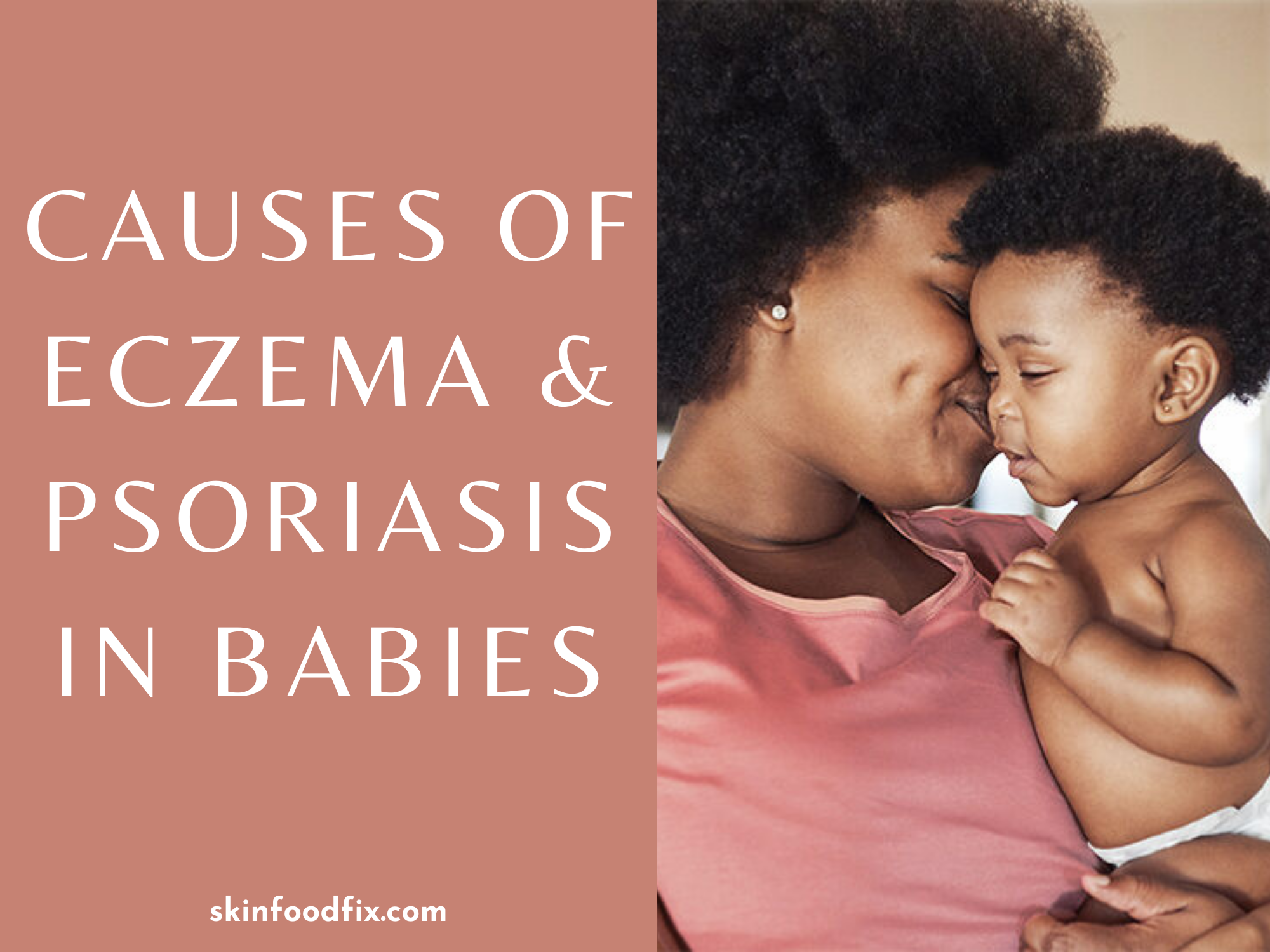 Eczema Cream Baby Child Children, Psoriasis Itchy Rash Bumps – SkinFoodFix