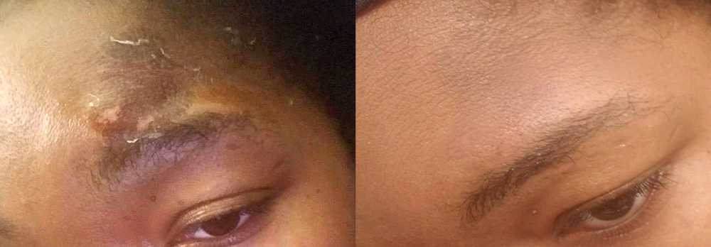 Scars Burns | Boils Cysts | Tamanu Oil – SkinFoodFix